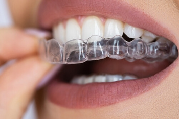 How Much Does Invisalign Cost? Everything You Need to Know - Good ...