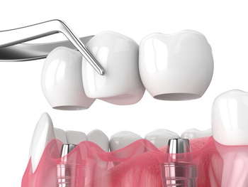 Dental Bridge Cost: Your Guide to Affordable Options