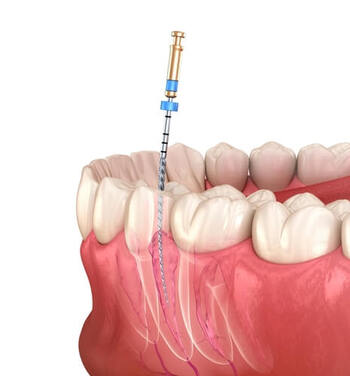 How Long Does a Root Canal Take? Your Guide to the Process